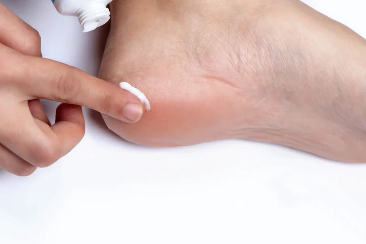 Everything You Need To Know About Blisters! – DrLuigi