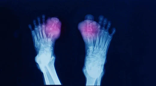 Understanding Tophaceous Gout: Symptoms, Diagnosis, and Treatment – DrLuigi